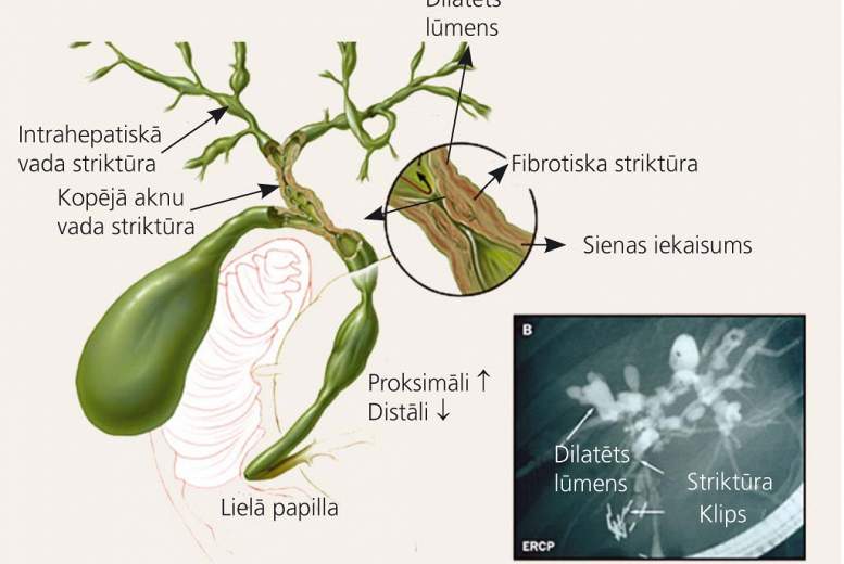 Aknu transplantācija - gastroenterologa skatījums — Doctus
