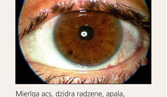 Katarakta — Doctus