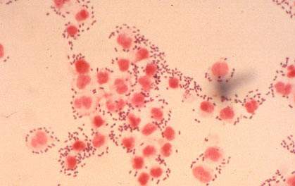 Gonoreja – diagnostika, komplikācijas un terapija — Doctus