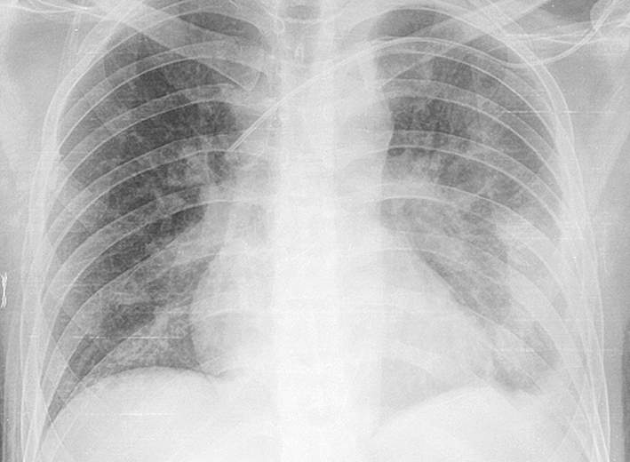 Mikoplazmu pneimonija jaunam vīrietim — Doctus