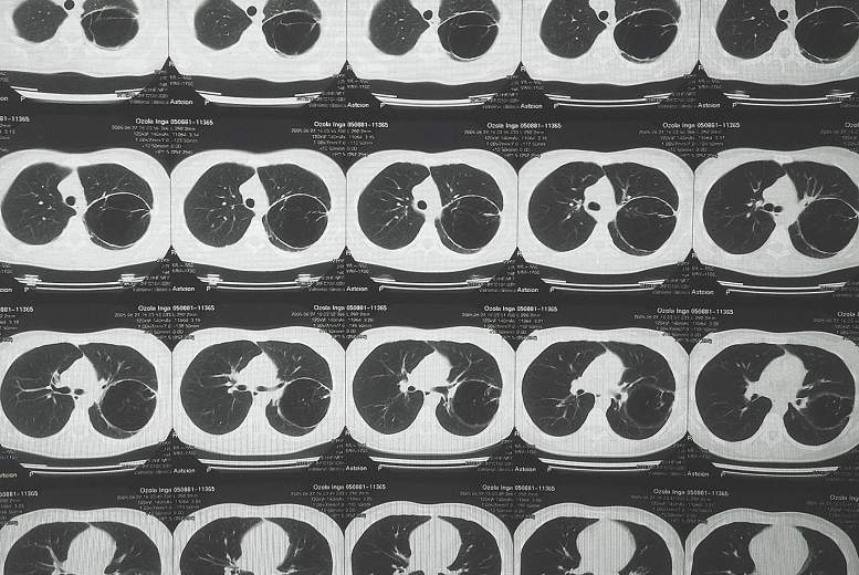 Recidivējoša kreisās plaušas bulloza emfizēma — Doctus