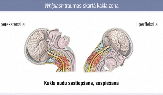 Galvas un kakla sāpes pēc kakla traumas neirologa un fi... — Doctus