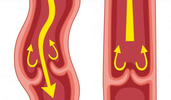 Vēnu varikoze. Vai tikai kosmētisks defekts? — Doctus