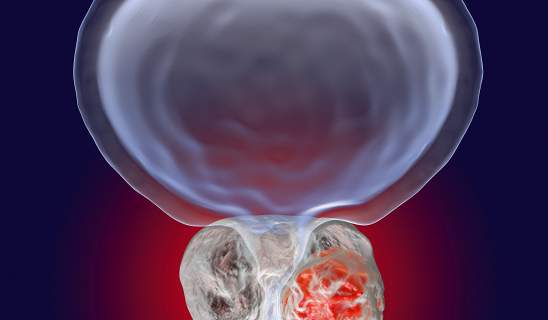 Labdabīga prostatas hiperplāzija un prostatas vēzis soļa attālumā — Doctus